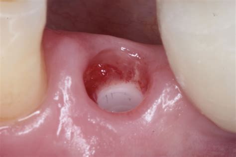 Ceramic Implants With Immediate And Delayed Loading In Aesthetic