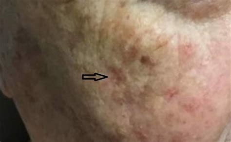 Clinical Challenge Rash On Thigh Mpr