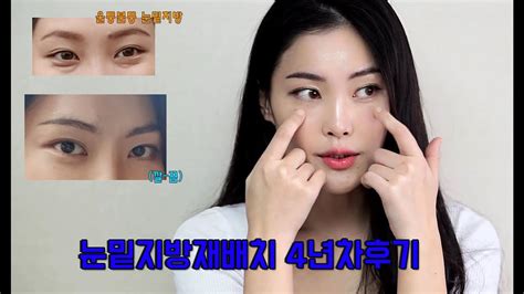 눈밑지방재배치 4년차 찐후기 Youtube