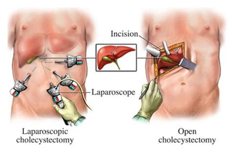Laparoscopic Surgery Aj Manavta Hospital