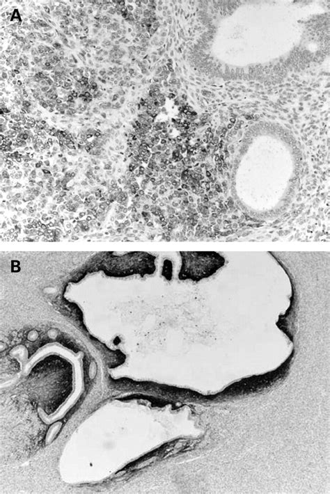 Uterine Adenosarcomas Overgrown By Sex Cord Like Tumour Report Of Two Cases Journal Of