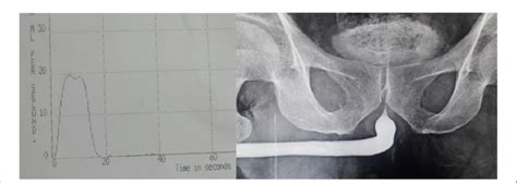 Normal Post Operative Uro Ometry And Retrograde Urography At Three