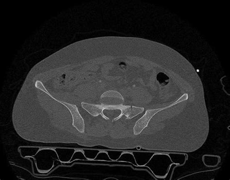 Pelvic Ring Fractures Trauma Orthobullets