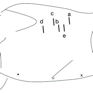 The Schema Of Thoracoscopic Port Placement In The Semiprone Position