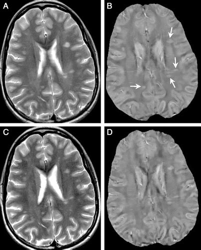 Quantitative Susceptibility Mapping Of Multiple Sclerosis Lesions At