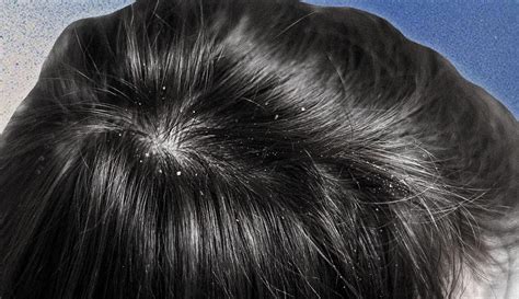 รงแคเปยกคออะไร และถาเปนแลวตองรกษาอยางไร