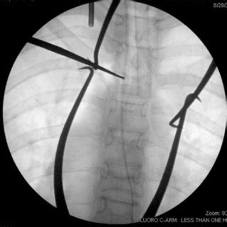 Standing Spinal X Rays Shows A Compression Fracture Of T7 Vertebral Download Scientific Diagram
