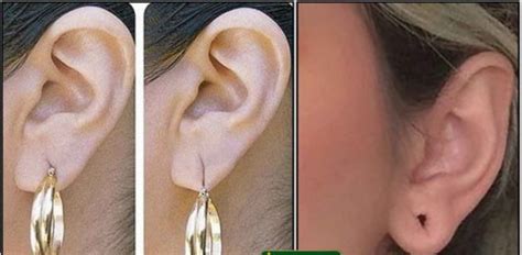 Ear Hole Closing Without Surgery Archives Dheivegam