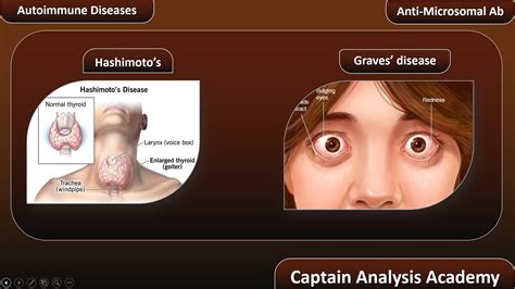 Anti Tpo Anti Microsomal Ab تشخيص أمراض الغدة Thyroid Youtube