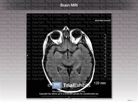 Brain Mri Trialquest Inc