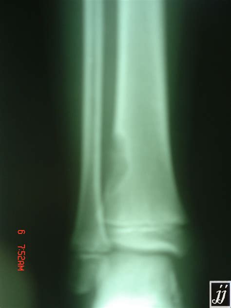 Tibial Cortical Defect Or Non Ossifying Fibroma Radiopaedia