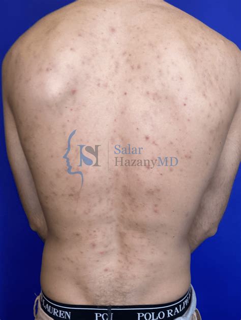Severe Acne Scars Back