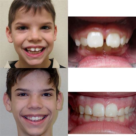Before And After Braces Wazio Orthodontics