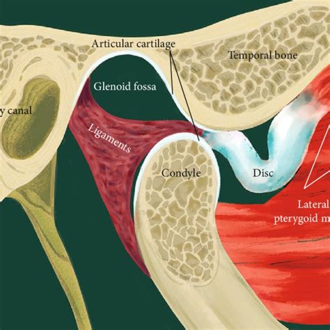 Tmj Anterior Disc Displacement Without Reduction Addwor Download