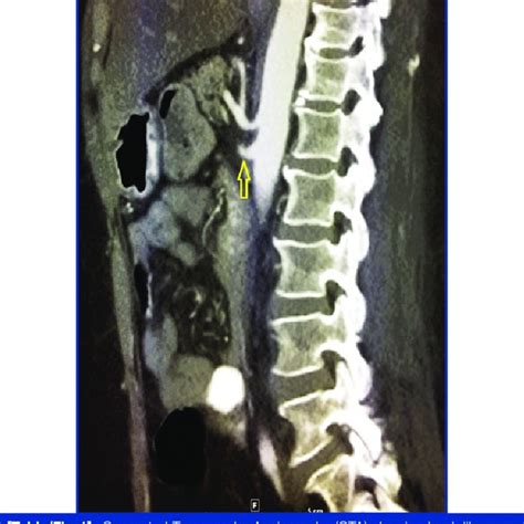 Median Arcuate Ligament Syndrome In 72 Year Old Male Patient A