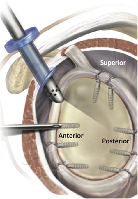 What Is Arthroscopic Labral Repair At Jon Lefebre Blog