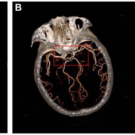 Definitive Hemorrhage Pattern To Confirm The Ruptured Aneurysm For