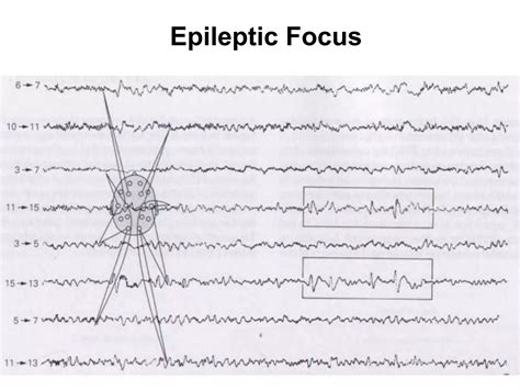 Diagrams Eeg Epilepsy Ppt