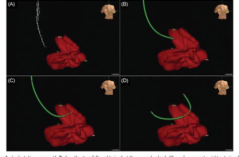Figure 1 From Implantation Of Single Lead Atrioventricular Permanent