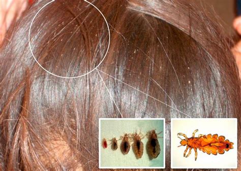 Как выглядят вши на голове у ребенка фото и подробное описание паразитов