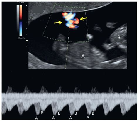 Multiple Pregnancies In The First Trimester Radiology Key