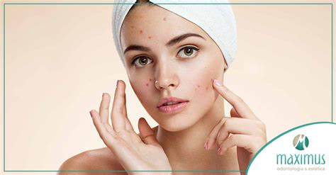QUAIS OS TIPOS DE ACNE Maximus Clinica e Estética