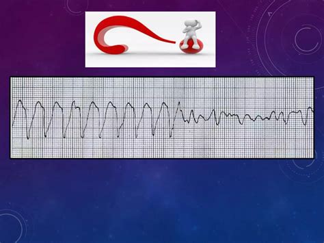 Acls Ekg Quiz Ppt