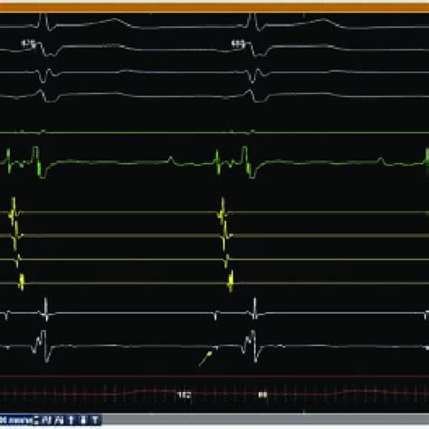 The Arrow Depicts The Slow Pathway Potential Located At Approximately