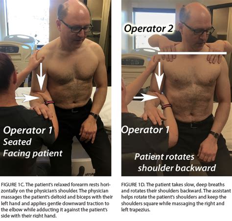 Incrementalization Of The Cunningham Technique For Anterior Shoulder