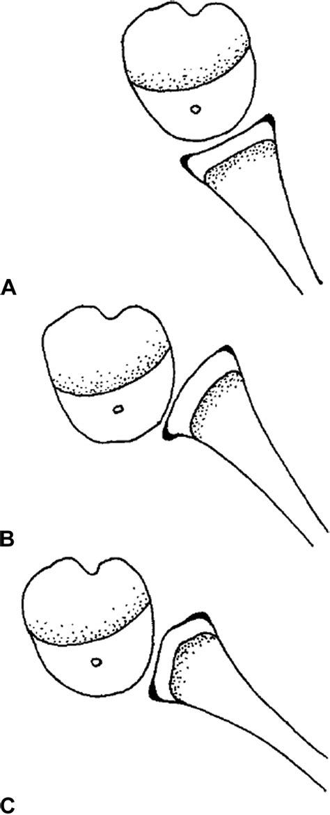 Glenohumeral Dysplasia Following Neonatal Brachial Plexus Palsy