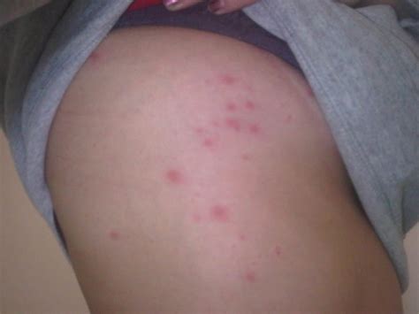 The Best Ways To Cure Common Skin Infections Healthtian