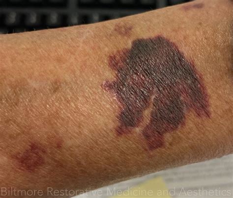 Bruising After Dental Local Anesthesia At Brooke Rentoul Blog