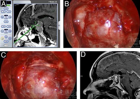 Endoscopic Transsphenoidal Pituitary Surgery Operative Techniques In