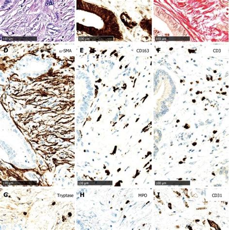 Main Components Of The Tumour Stroma In Pan­ Creatic Cancer A