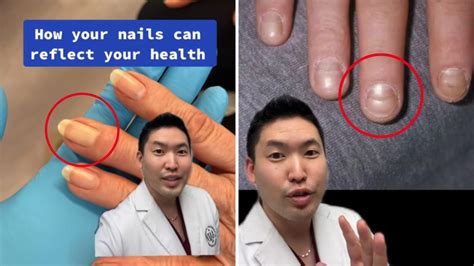 What Do Your Nails Say About Your Health Doctor Shares The Common