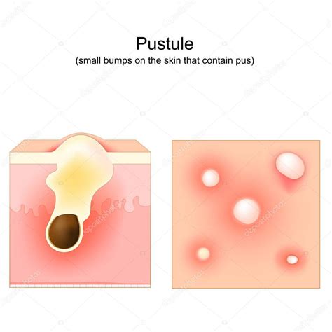 Acné La pustula es un pequeño bulto en la piel que contiene pus Corte