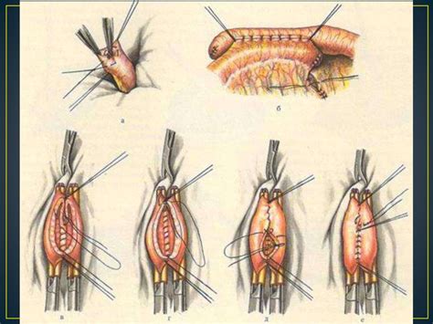 Enterectomy Online Presentation