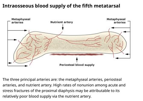 Case Report Fifth Metatarsal Fracture Sports Medicine Review