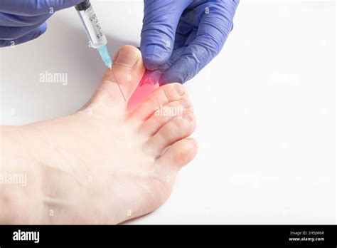 The Doctor Makes An Injection Between The Toes Against Hyperhidrosis