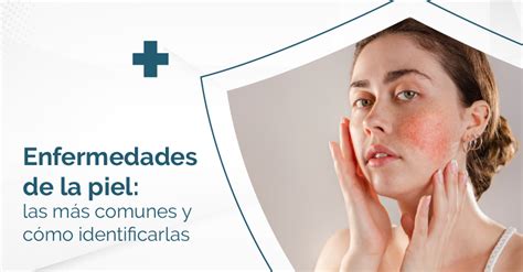 Enfermedades De La Piel Las Más Comunes Y Cómo Identificarlas