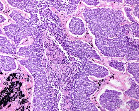 Small Cell Lung Carcinoma 3 By Jose Calvo Science Photo Library