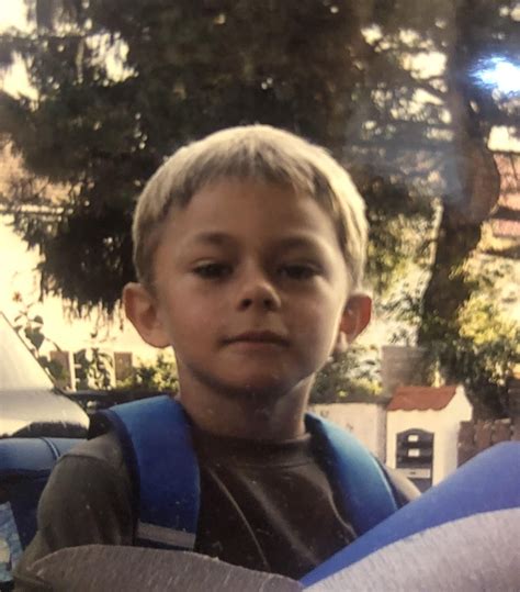 Is This Midline Discrepancy And Eye Asymmetry Still Fixable At 24 R Orthotropics