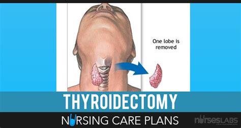 6 Thyroidectomy Nursing Care Plans Nursing Care Plan Thyroidectomy
