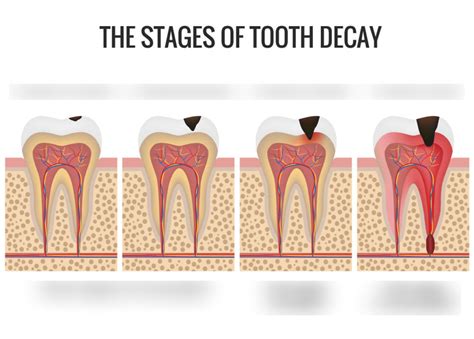 Stages Of Tooth Decay Diagram Quizlet