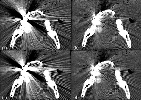 A Newly Developed Metal Artifact Reduction Algorithm Improves The Visibility Of Oral Cavity