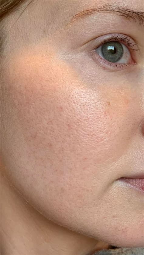 Metronidazole Gel Before1 Week After Use3 Weeks After Useimprovement Rrosacea