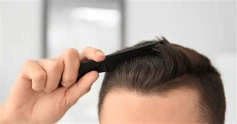 Hormonal Hair Loss Treatment A Comprehensive Guide