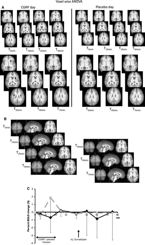 One Way Voxel Wise Anova Results From The Measured Time Points At The