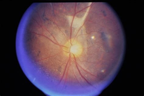 Pattern Dystrophy Retina Image Bank