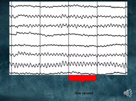 Eeg Basic To Practice Ppt